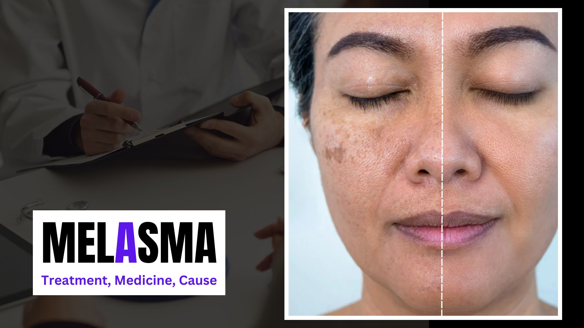 Melasma: Treatment, Causes & Prevention - Fitbynet