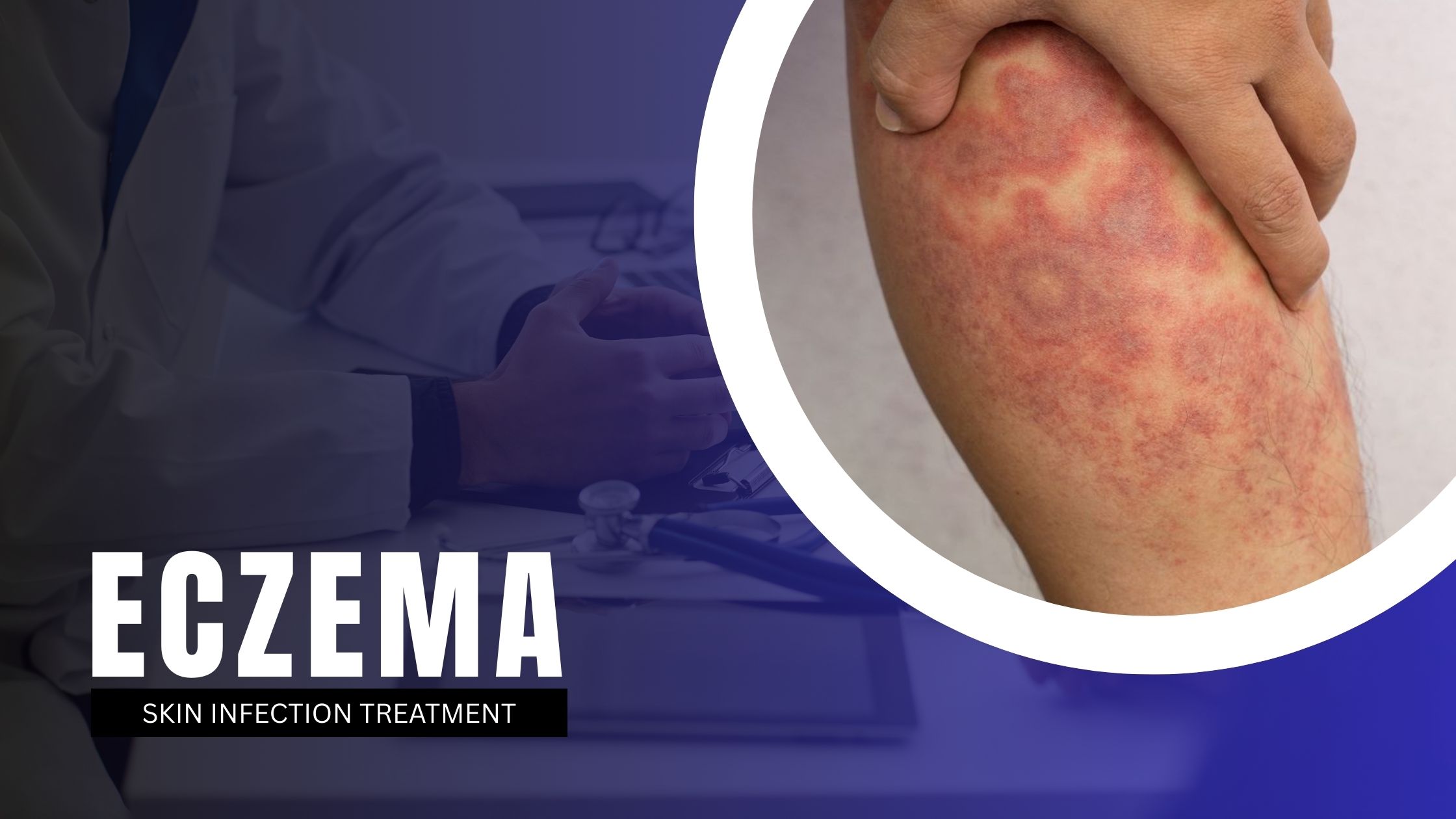 Eczema – Types, Symptoms, Causes, and Treatment - Fitbynet